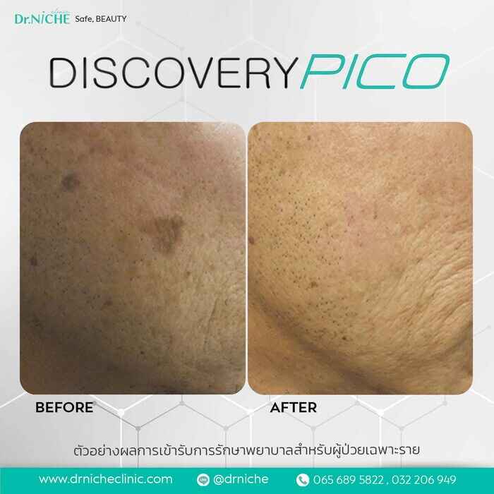 Discovery Pico Laser | ผิวเนียนใส ตั้งแต่ครั้งแรก