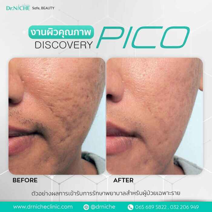 Discovery Pico Laser | ผิวเนียนใส ตั้งแต่ครั้งแรก